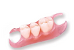 Flipper | Partial Denture – Direct Dental Prosthetics