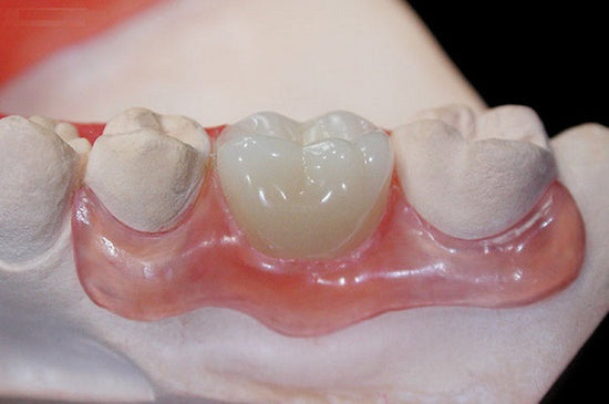 Flipper | Partial Denture – Direct Dental Prosthetics