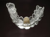 Clear Essix Pontic Retainer – Direct Dental Prosthetics
