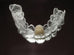 Clear Essix Pontic Retainer – Direct Dental Prosthetics