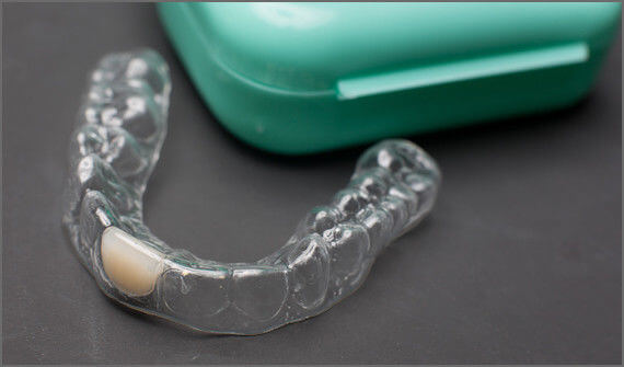Clear Essix Pontic Retainer – Direct Dental Prosthetics