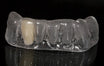 Clear Essix Pontic Retainer – Direct Dental Prosthetics